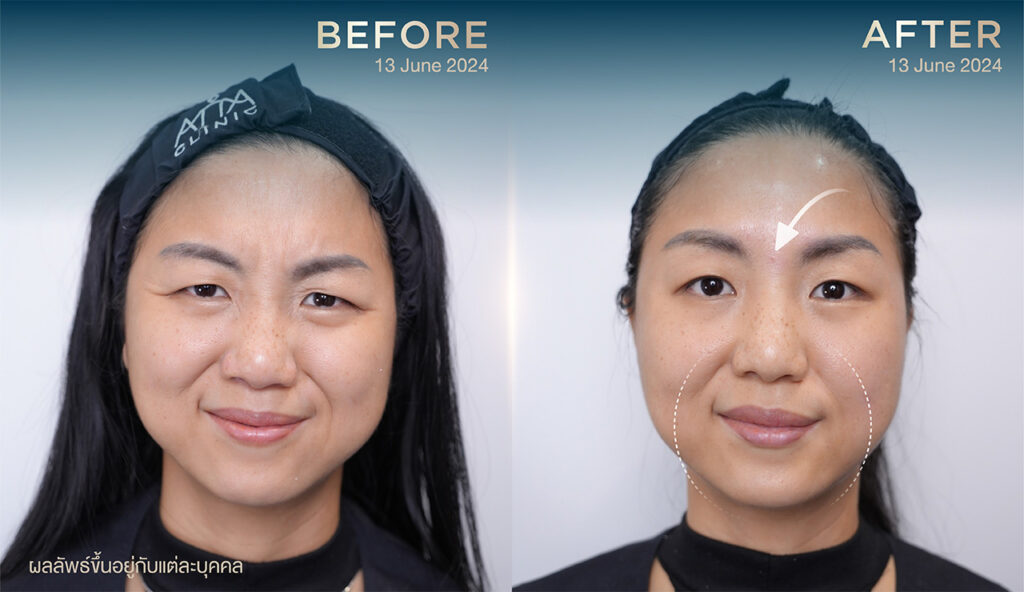 Anti-Wrinkle Program - ATTA Clinic