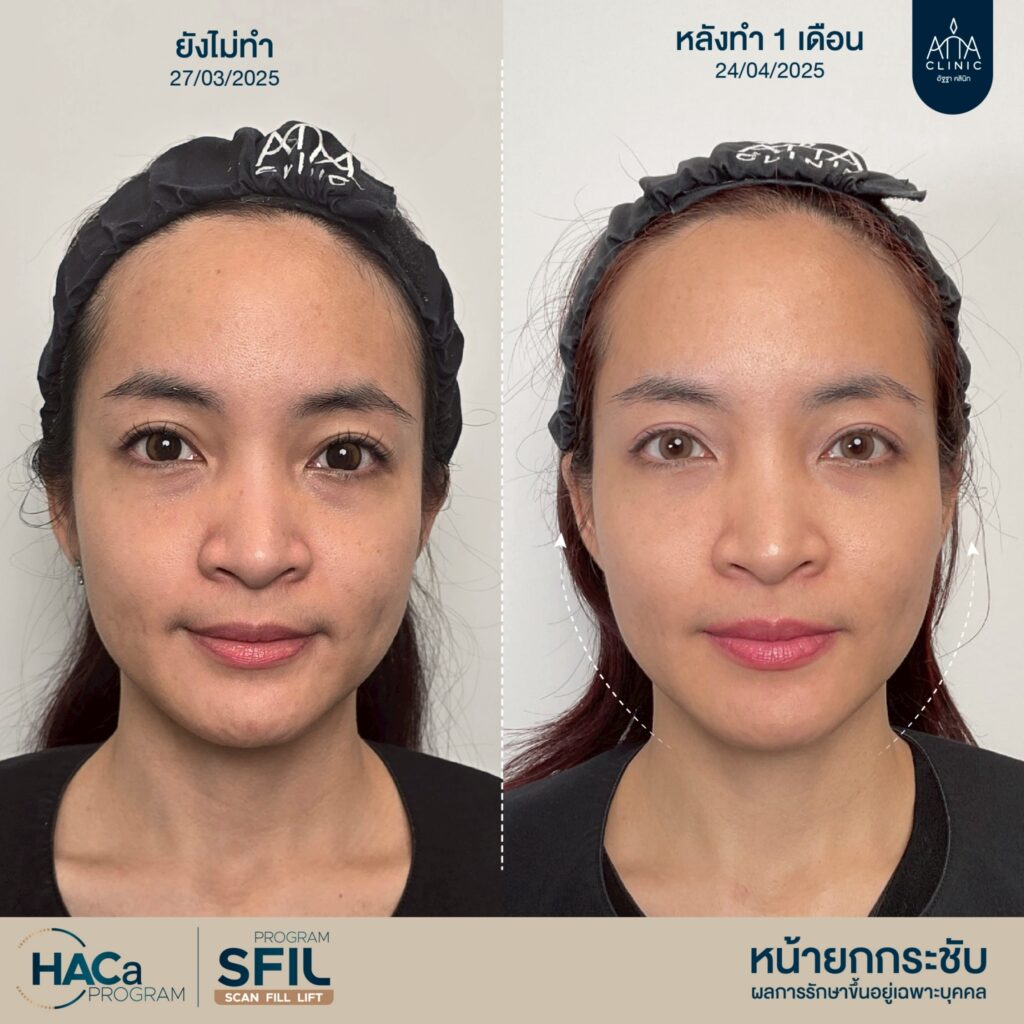เทียบ 3 โปรแกรม Profhilo, Biostimulator และ HACA | อัฐฐา คลินิก